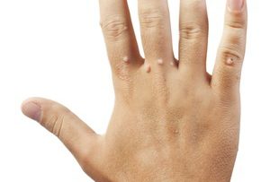 Warts - Treatments For Warts Available From Dr. Gergana Gallacher ...